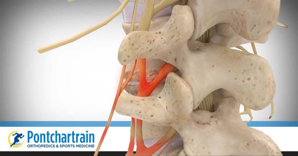 Spinal Stenosis - Pontchartrain Orthopedics & Sports Medicine