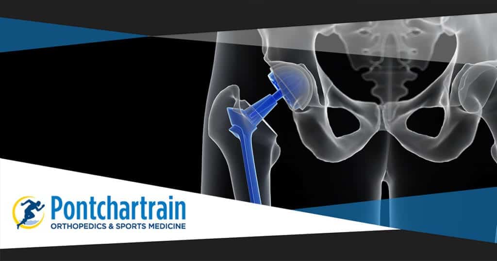 Hip Replacement Surgery - Pontchartrain Orthopedics