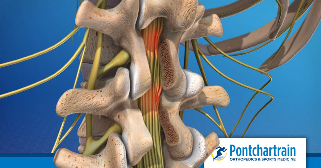Failed Back Surgery Syndrome - Pontchartrain Orthopedics & Sports Med