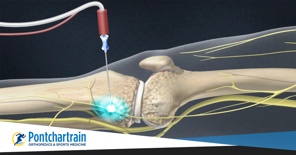 RFA for Chronic Knee Pain - Pontchartrain Ortho & Sports Medicine