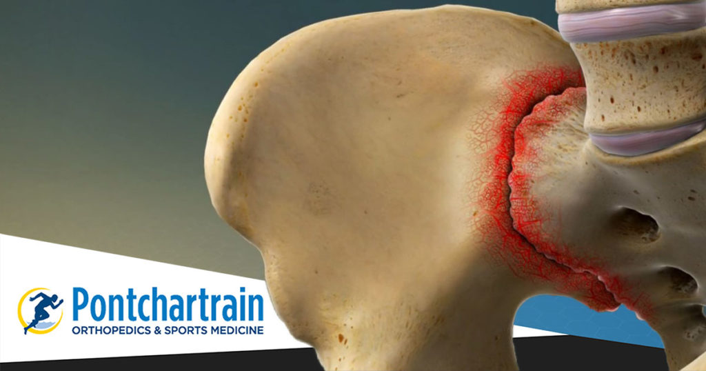 Sacroiliac Joint Pain - Pontchartrain Orthodepics & Sports Medicine