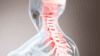 Spasmodic Torticollis: Understanding and Managing the Condition ...